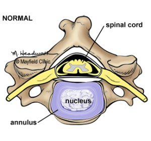 Pars Fracture (Spondylolysis) – Meet Dr. Joel Edionwe