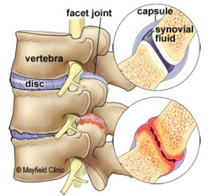Pars Fracture (Spondylolysis) – Meet Dr. Joel Edionwe