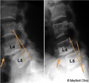 Pars Fracture (Spondylolysis) – Meet Dr. Joel Edionwe